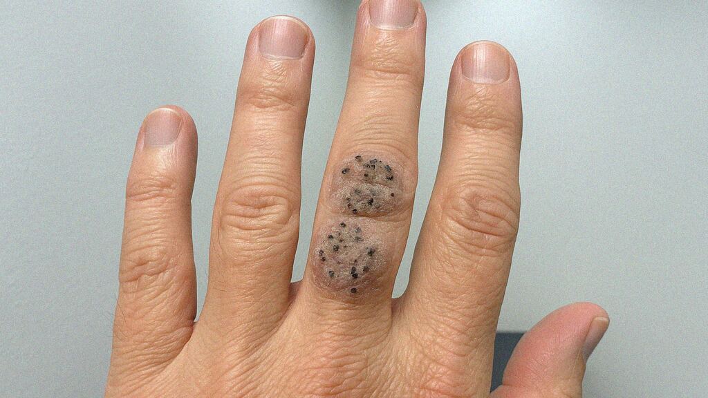 Hyperkeratotic Papules with Black Dots on the Dorsal Fingers | Verruca ...